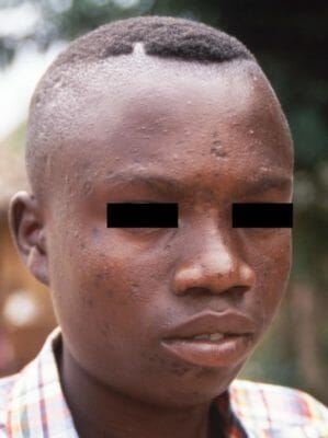 Mpox (Monkeypox) | Concise Medical Knowledge