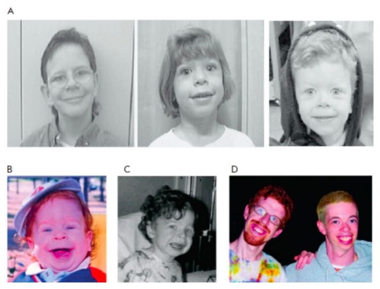 Williams Syndrome | Concise Medical Knowledge