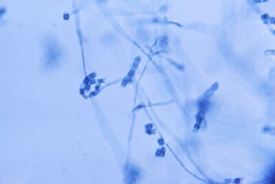 Coccidioides/Coccidioidomycosis | Concise Medical Knowledge