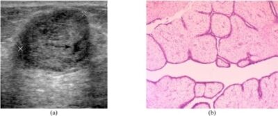 Patologias Benignas da Mama | Concise Medical Knowledge