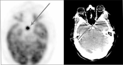 Adenomas Hipofisários | Concise Medical Knowledge