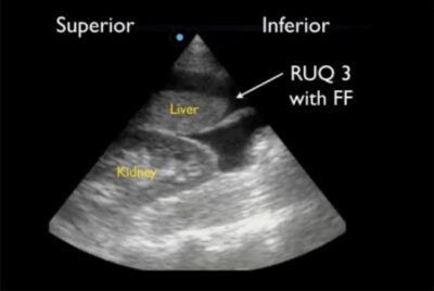 Evaluación Enfocada con Ultrasonido para Traumatismos (FAST) | Concise Medical Knowledge