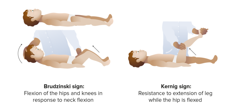 Acute Disseminated Encephalomyelitis (ADEM) | Concise Medical Knowledge