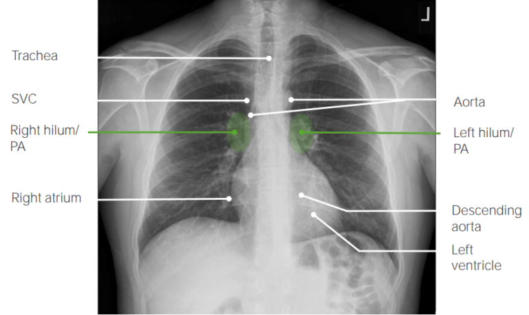 Imaging of the Mediastinum | Concise Medical Knowledge