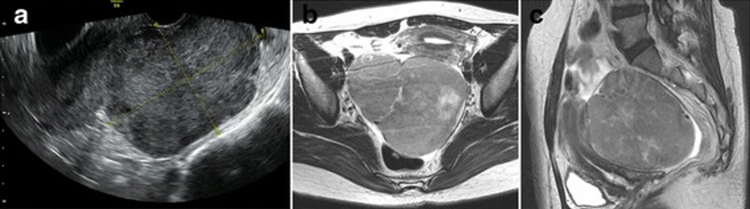 Cáncer de Ovario | Concise Medical Knowledge