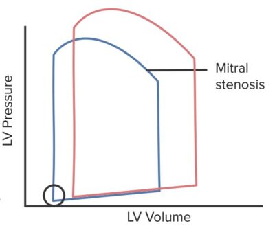 Mitral Stenosis | Concise Medical Knowledge