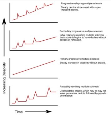Esclerosis Múltiple | Concise Medical Knowledge