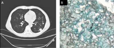 Cryptococcus/Cryptococcosis | Concise Medical Knowledge