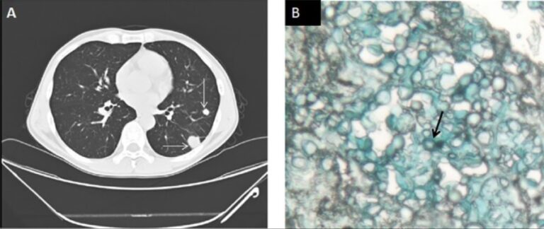 Cryptococcus/Cryptococcosis | Concise Medical Knowledge