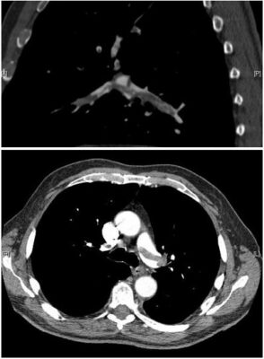 Pleuritis | Concise Medical Knowledge