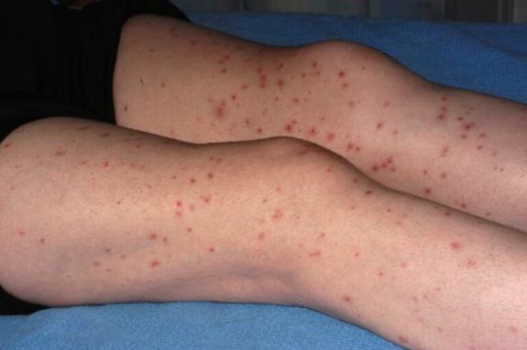 Lesiones Cutáneas Secundarias | Concise Medical Knowledge