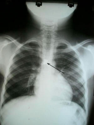 Anomalias Torácicas Pediátricas | Concise Medical Knowledge