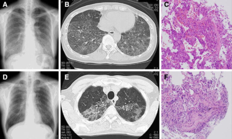 Hypersensitivity Pneumonitis | Concise Medical Knowledge