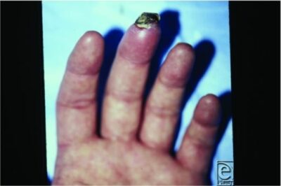 Tromboangeíte Obliterante (Doença de Buerger) | Concise Medical Knowledge