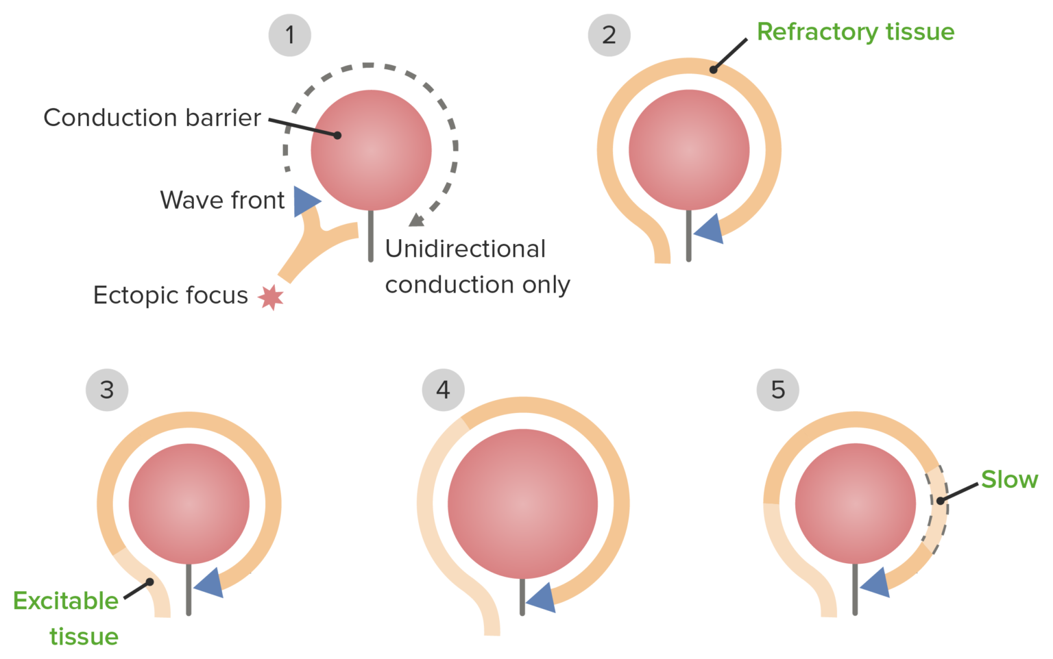 Atrial Fibrillation (Clinical) | Concise Medical Knowledge