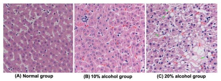 Alcoholic Liver Disease