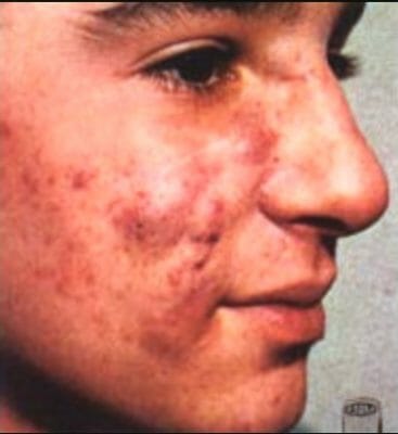 Aromatase Deficiency | Concise Medical Knowledge