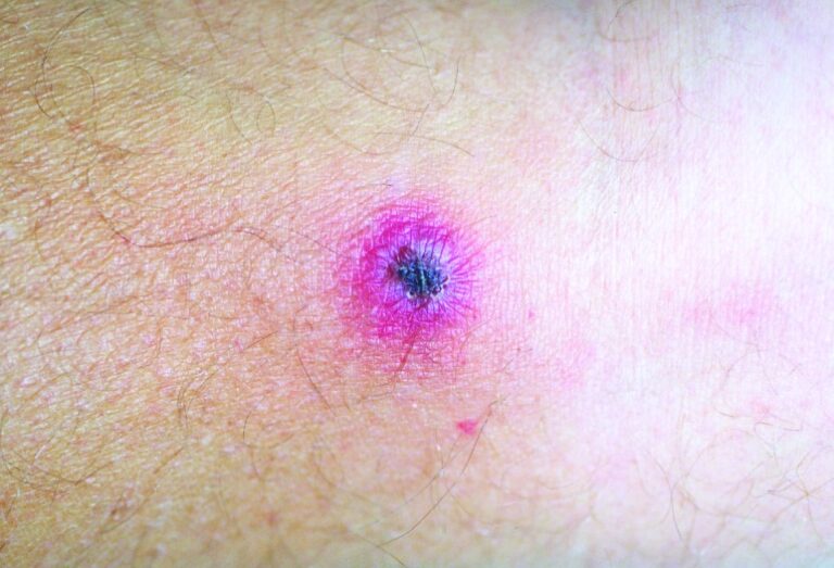 Rickettsia | Concise Medical Knowledge