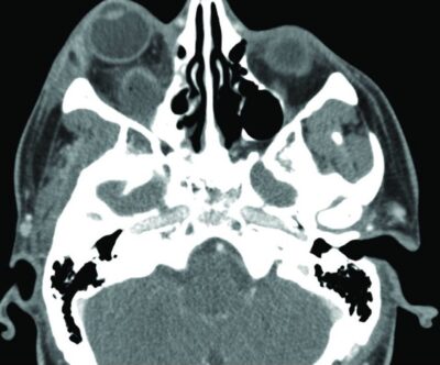 Celulitis Orbitaria y Preseptal | Concise Medical Knowledge