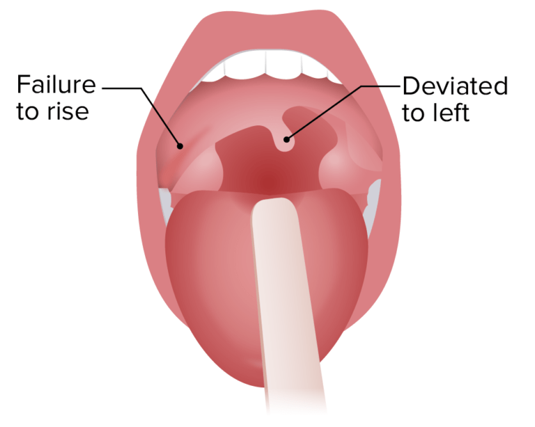 Cranial Nerve Palsies | Concise Medical Knowledge
