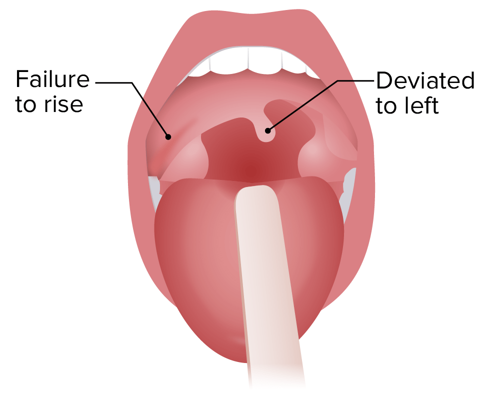 Uvula Deviation Uvula Deviation