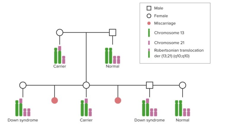 Down syndrome (Trisomy 21) | Concise Medical Knowledge
