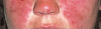 Systemic Lupus Erythematosus | Concise Medical Knowledge