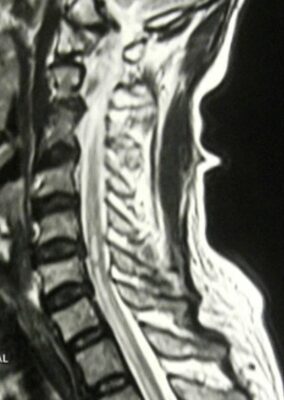 Síndrome Medular Anterior | Concise Medical Knowledge