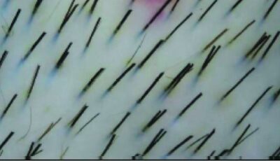 Alopecia | Concise Medical Knowledge