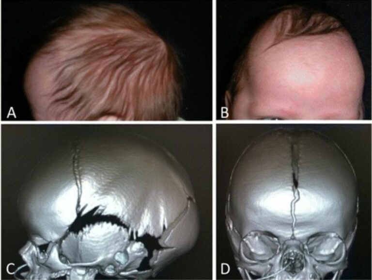 Craniosynostosis | Concise Medical Knowledge