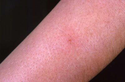 Insect And Scorpion Stings Concise Medical Knowledge