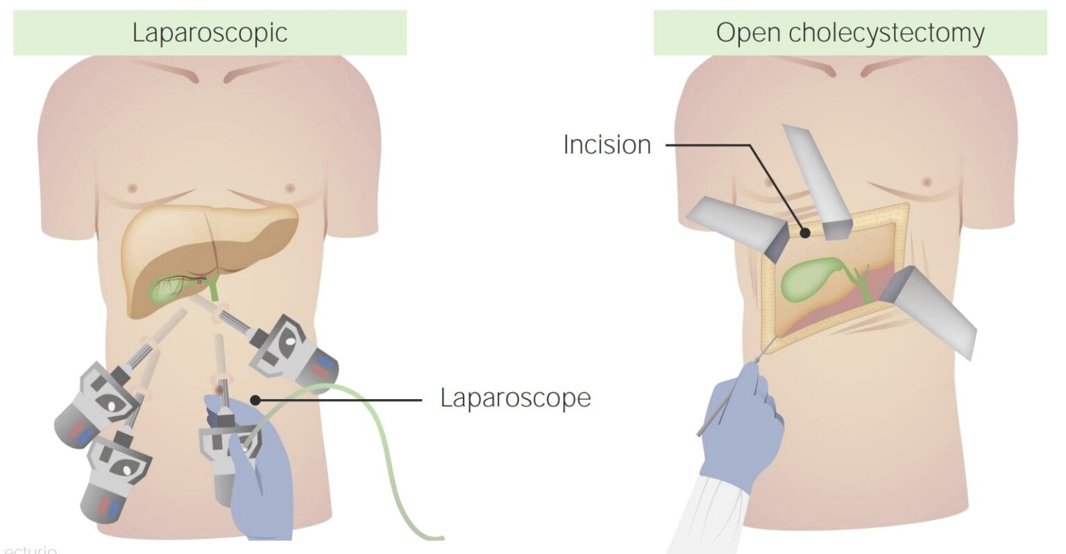 T-Tube Care [+ Free Cheat Sheet] | Lecturio Nursing
