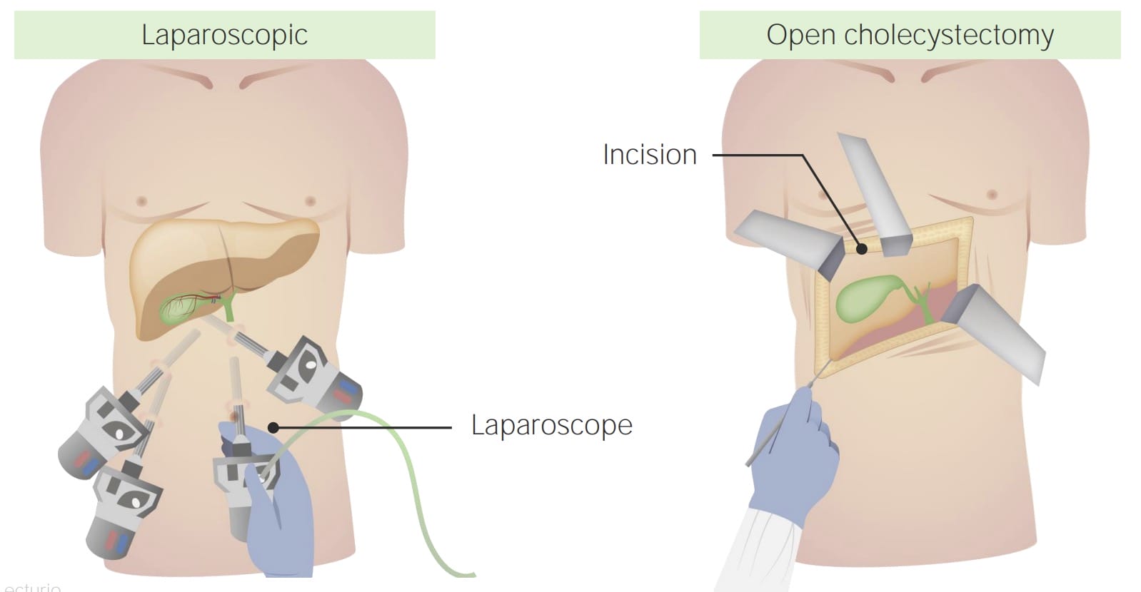 T-Tube Care [+ Free Cheat Sheet] | Lecturio Nursing