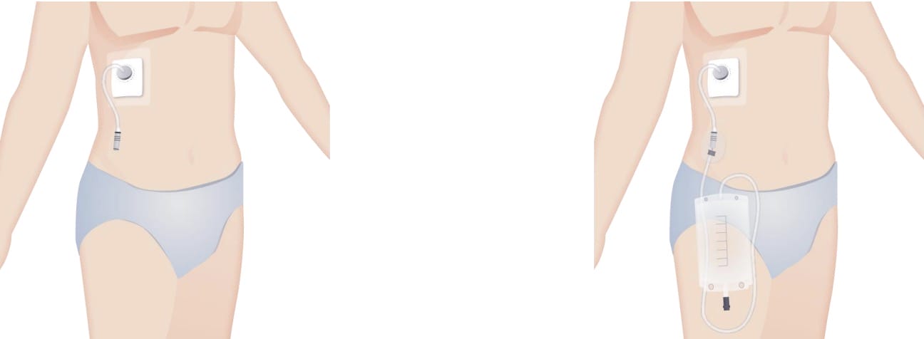 T-Tube Care [+ Free Cheat Sheet] | Lecturio Nursing