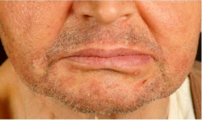 Generalized and Localized Rashes | Concise Medical Knowledge