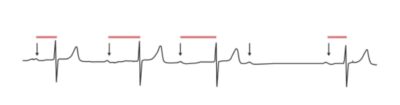 Atrioventricular block (AV block) | Concise Medical Knowledge