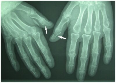 Hyperparathyroidism (Clinical) | Concise Medical Knowledge