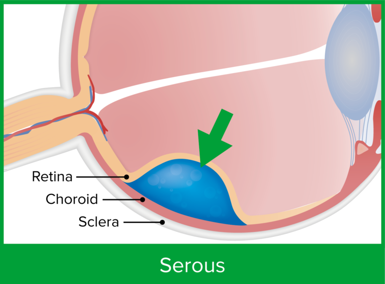Desprendimiento de Retina | Concise Medical Knowledge