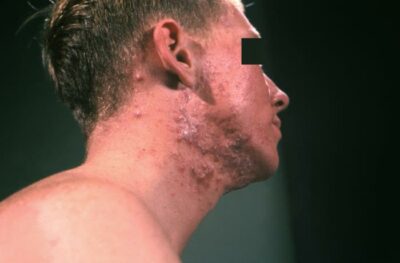 Acne Vulgaris | Concise Medical Knowledge