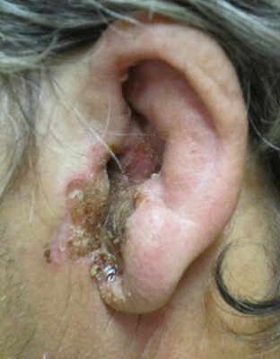 Otitis Externa | Concise Medical Knowledge