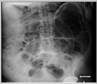 Obstrução do Intestino Grosso | Concise Medical Knowledge