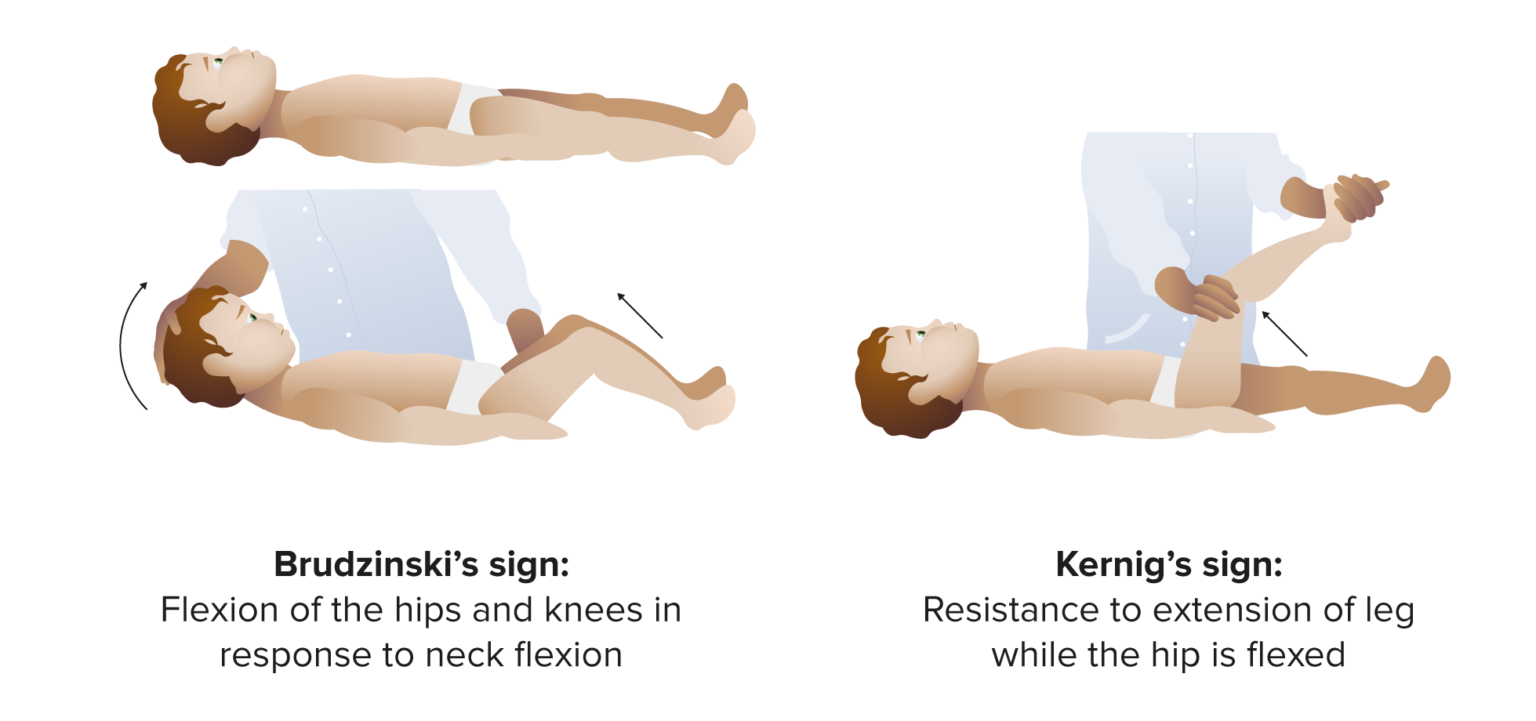 Meningite em Crianças | Concise Medical Knowledge Meningite em Crianças | Concise Medical Knowledge
