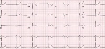 Bradyarrhythmias | Concise Medical Knowledge