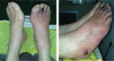 Acute Limb Ischemia | Concise Medical Knowledge