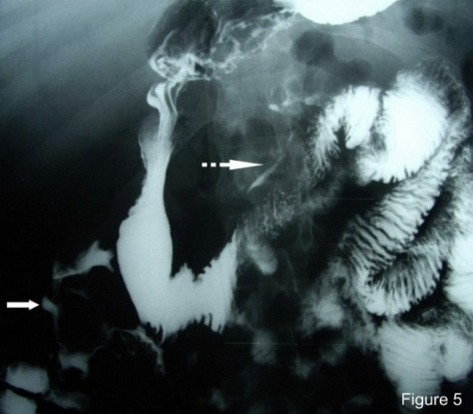 Imagenología Intestinal | Concise Medical Knowledge