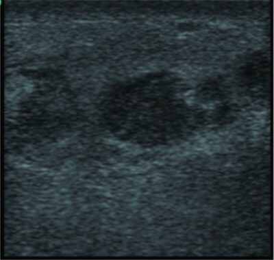 Soft Tissue Abscess | Concise Medical Knowledge