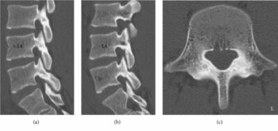 Imaging of the Spine and Spinal Cord | Concise Medical Knowledge