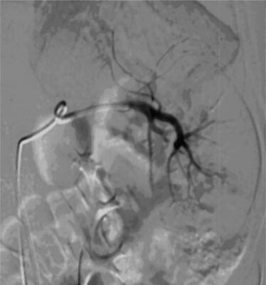Rupture of the Spleen | Concise Medical Knowledge
