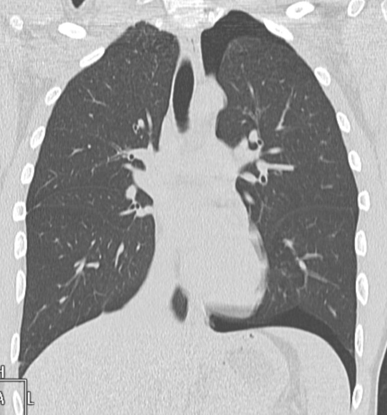Neumotórax | Concise Medical Knowledge