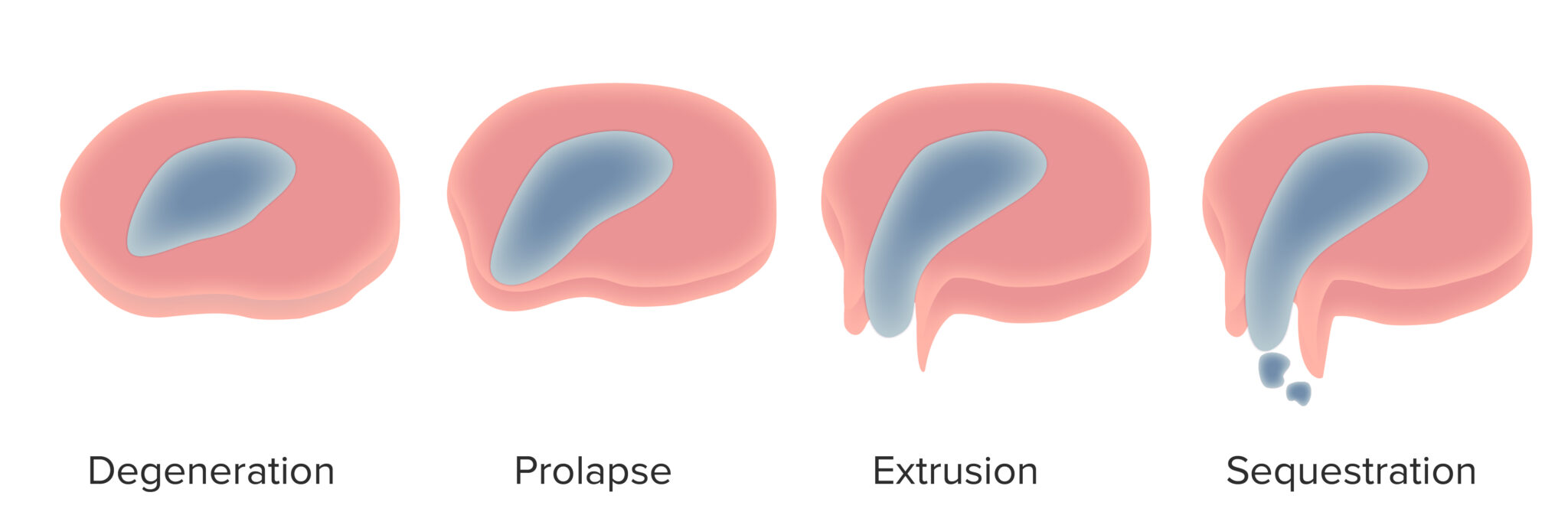 Spinal Disk Herniation | Concise Medical Knowledge